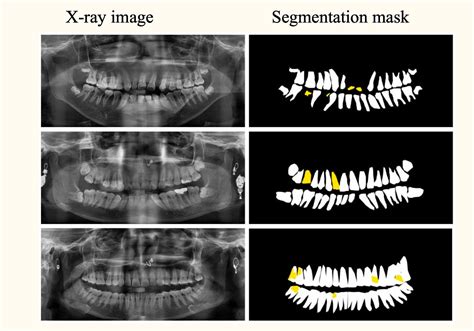 🦷 Automating Dental Caries Detection With Deep Learning A U Net Based Approach By