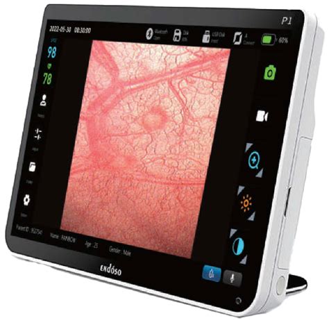 Endoso Single Use Digital Cystoscope