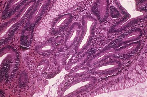 Intestinal Polyp Light Micrograph Stock Image C022 7170 Science Photo Library