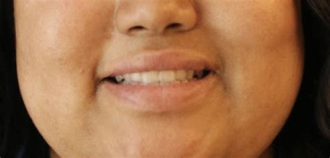 Lip Reduction To Address Silicone Injection Deformities The Kaplan Center