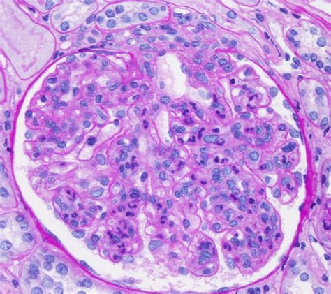 Post Streptococcal Glomerulonephritis Slide At Caitlyn Lavater Blog