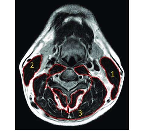 Muscle Contours In The Left Sternocleidomastoid Muscle 1 Right Download Scientific Diagram