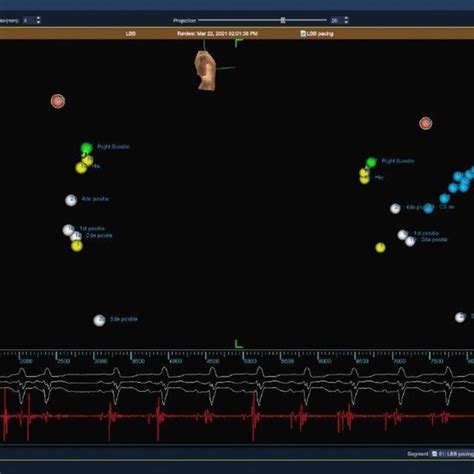 3 Dimensional Electro Anatomical Mapping To Identify And Tag The Download Scientific Diagram