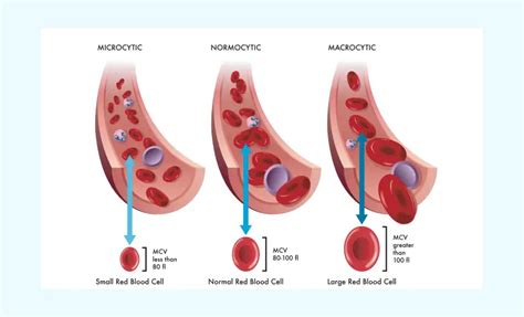 Mean Corpuscular Volume MCV Blood Test Purpose Procedures Test Results And Normal Range