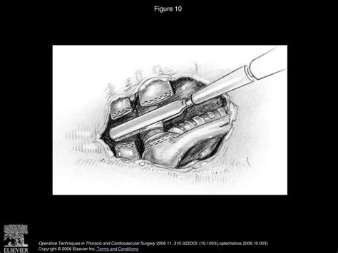 Lung Segmentectomy For Patients With Peripheral T1 Lesions Ppt Download
