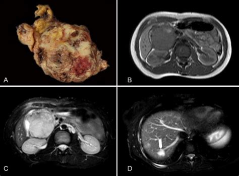 Solid Pseudopapillary Neoplasm Spn In A 17 Year Old Female With Liver Download Scientific