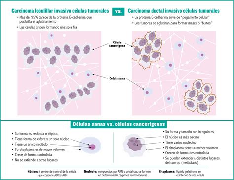 Ilc Vs Idc Infographic Espanol 11 21 The Lobular Breast Cancer Alliance
