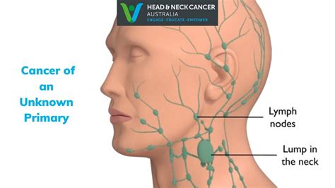 How Big Are Cancerous Lymph Nodes In Neck