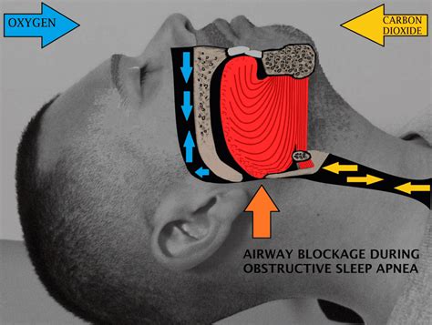 How To Treat Sleep Apnea Naturally At Home Sleep Care