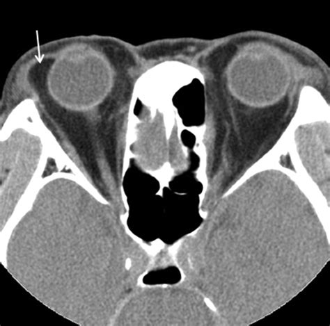 Subconjunctival Fat Prolapse And Dermolipoma Of The Orbit