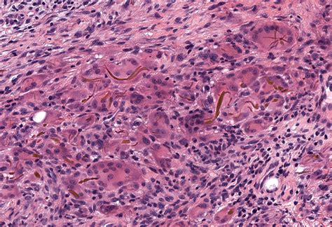 Ochronosis Histology