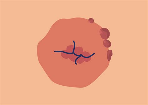 Stoma Granulomen Behandelen Eakin