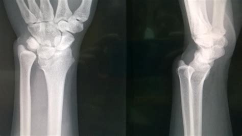 Madelungs Deformity Hand Orthobullets
