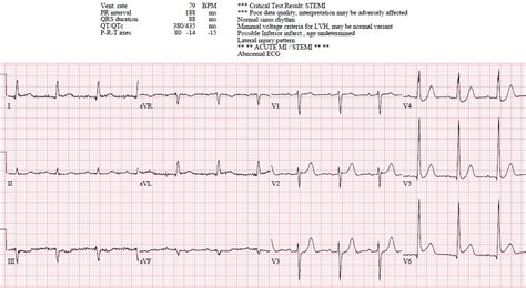 Lateral Stemi Or Occlusion Mi Ecg Cases Emergency Medicine Cases