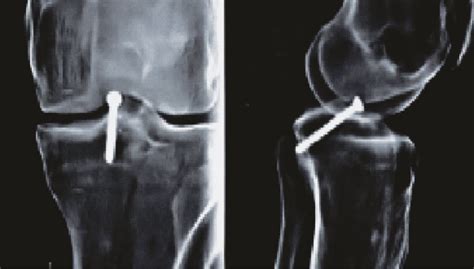 Asian Journal Of Arthroscopy Arthroscopic Reduction And Internal Fixation Arif Using