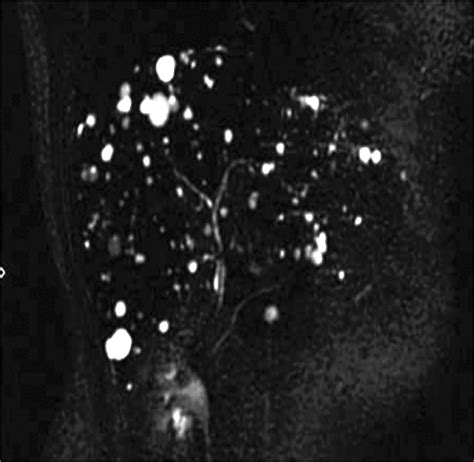 Lightbulbs Of The Biliary Tree A Radiological Finding In Christmas