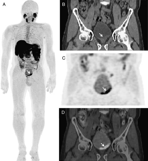 Incidental Papillary Bladder Carcinoma On 18f Fluoromethylch