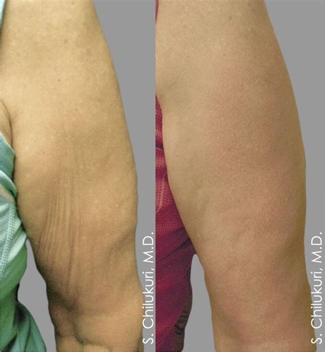 Body Sculpting In Houston Refresh Dermatology