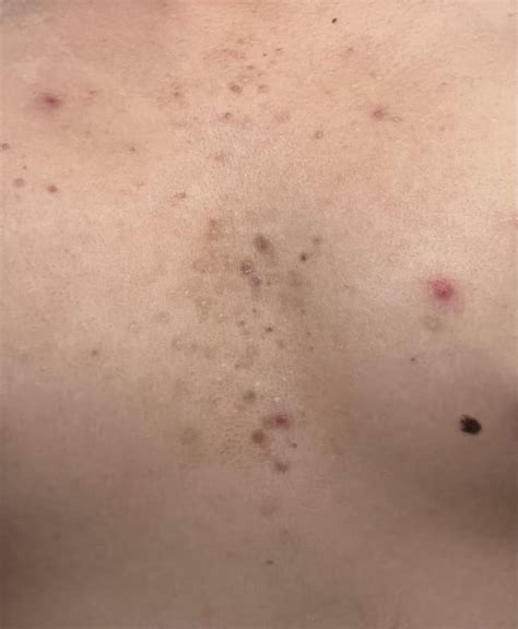 Are These Acne Scars On My Chest And Back Still Treatable Or Are They