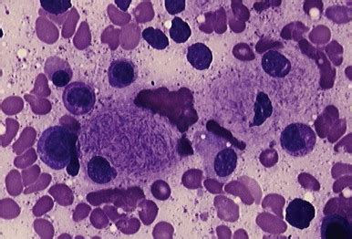 Lysosomal Storage Diseases Oncohema Key