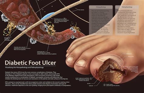 Diabetic Foot Ulcers Surgery Options To Treat And Prevent Podiatric