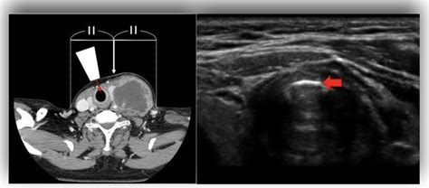Airway Pocus Cricothyrotomy — Usf Emergency Medicine