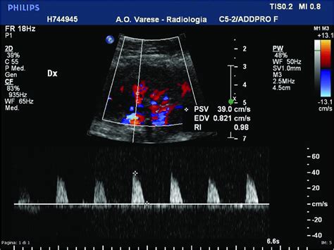 Doppler Us Renal Resistive Index Increase Up To 0 9 1 And Decrease Of