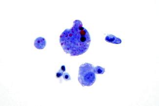 The Cytologic Makeup Of The Urinary Sediment According To The
