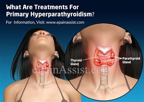 Primary Hyperparathyroidism Treatment Home Remedies Symptoms Causes