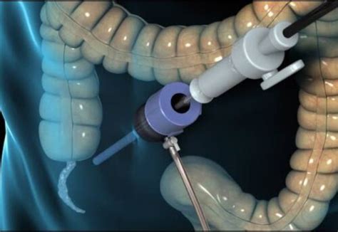 Advantages Of Laparoscopic Appendectomy Over Open Surgery Dr Samrat