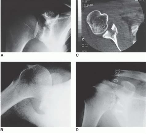 Open Reduction And Internal Fixation Of Glenoid Fractures Musculoskeletal Key