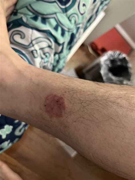 Psoriasis Ringworm Or Eczema Rdiagnoseme
