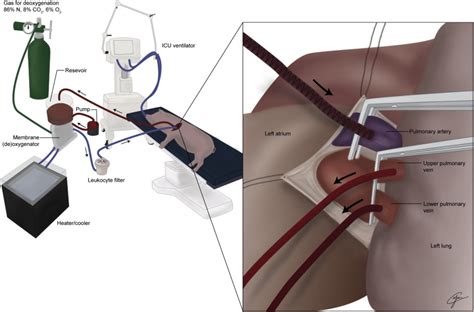Novel Technologies For Isolated Lung Perfusion Thoracic Surgery Clinics