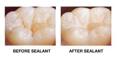 Dental Sealants