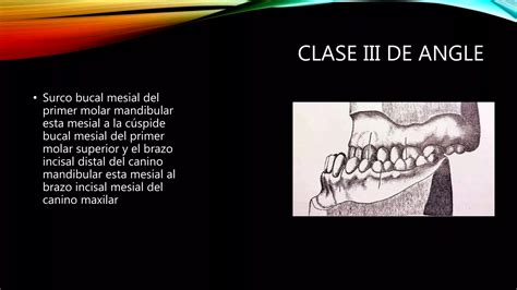 Clasificación Angle Maxi Pptx