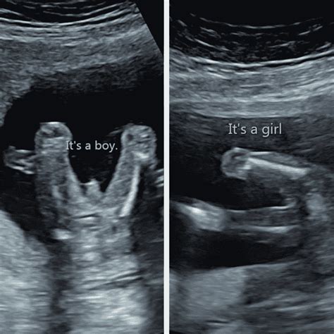 12 Week Ultrasound Girl Vs Boy 12 Week Ultrasound Girl Vs Boy