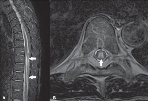 Scielo Brasil Magnetic Resonance Imaging Evaluation Of Spinal Cord
