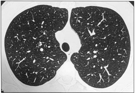 Hrct Image Of A 26 Yr Old Woman With Miliary Nodules 1 To 2 Mm Nodules