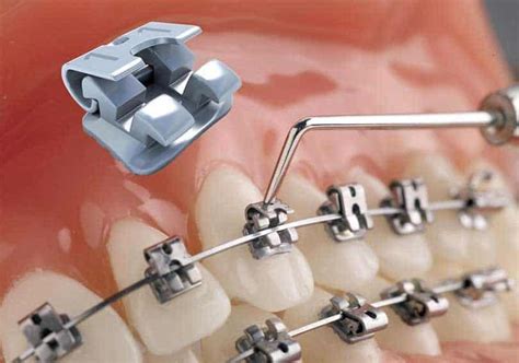 Types Of Ortho Brackets At Joseph Becher Blog