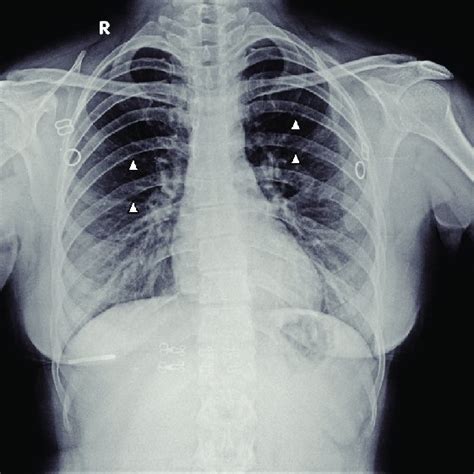 Chest X Ray Posteroanterior Pa View Of The Patient Shows Prominent