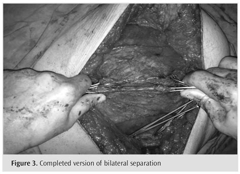 Is Component Separation A Safe Method In Incisional Hernias Istanbul Medical Journal Is