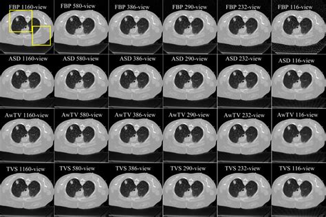 the images reconstructed by fbp 1 st row asd pocs 2 nd row