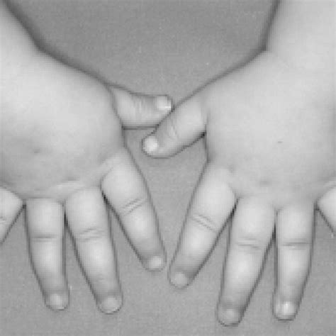 [pdf] Albrights Hereditary Osteodystrophy Pseudohypoparathyroidism Type Ia Clinical Case