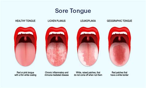 Ulcer Tongue Irritation
