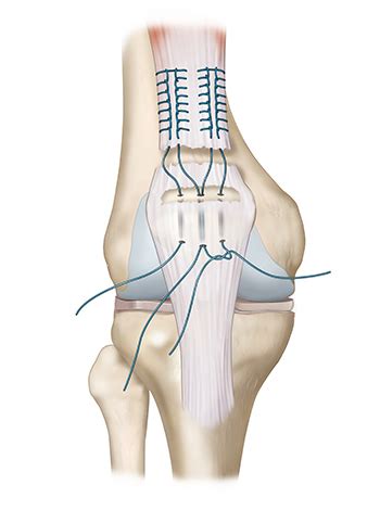 Quadriceps Tendon Injuries Accelerate Orthopedics