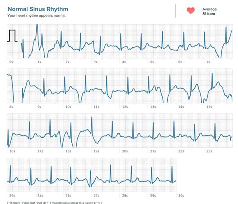 Why Do My Ecg Graphs Look Like This Rfitbit