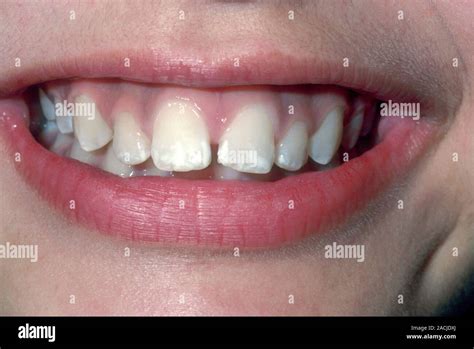 Overbite 10 Year Old Female With A 100 Per Cent Overbite Her Upper