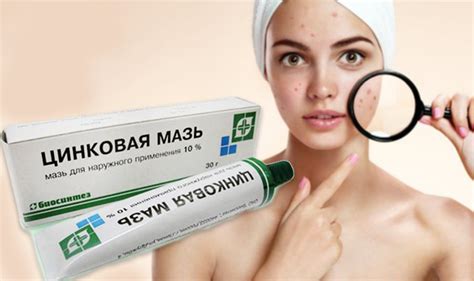 თუთიის მალამო იაფი და ეფექტური ხელმისაწვდომი პრეპარატი