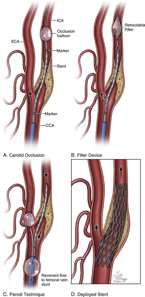 Carotid Revascularization Clinical Tree