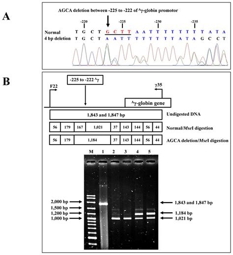 Molecular basis of a high Hb A2/Hb Fβ-thalassemia trait: a ...